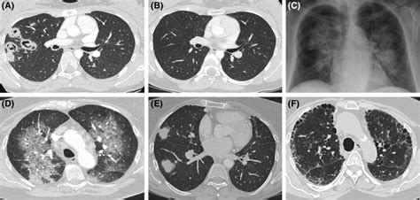 Heterogeneity Of Pulmonary Involvement In Anca Associated Vasculitis