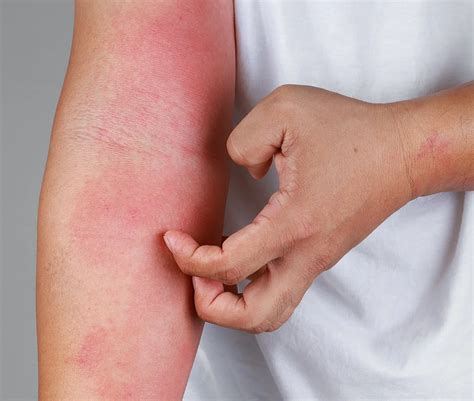 Dermatitis Eczema — Ascot Dermatology Dr Laura Wheller Brisbane Dermatologist