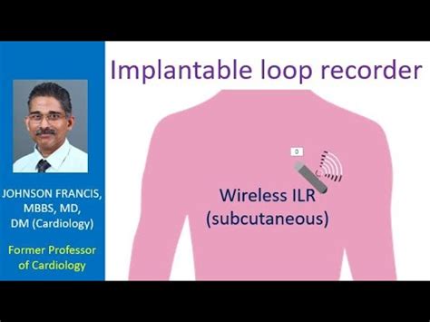 Implantable Loop Recorder Youtube