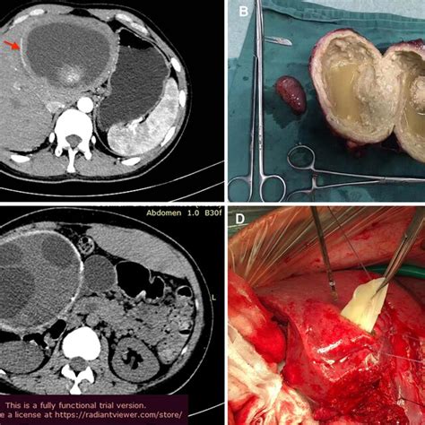 Typical Ae And Ce With Eggshell Like Calcification A Ae Lesion With