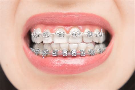 Self Ligating Brackets Vs Braces At Craig Alston Blog