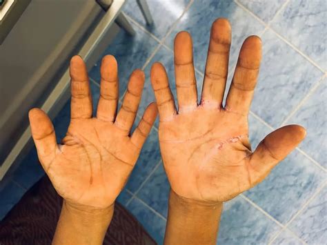 Kulit Jari Kering And Menebal Ia Mungkin Tanda Sklerosis Digital