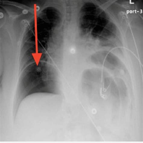 Posteroanterior Chest X Ray At The Time Of Gastric Perforation Download Scientific Diagram