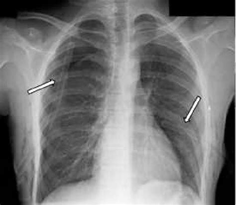 Postero Anterior Radiograph Of The Chest Shows Interval Placement Of