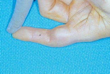 Giant Cell Tumor Finger Giant Cell Tumour Of Ehl Tendon Sheath In