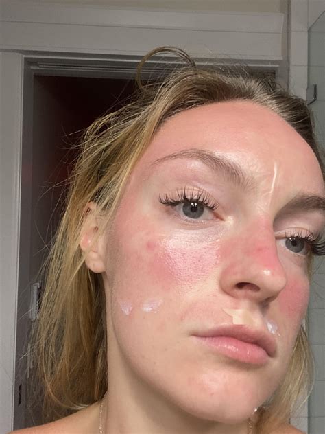 Malar Rash R Autoimmune