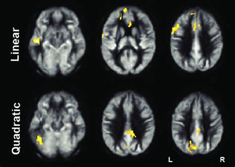 Results Of Cbf Voxel Based Comparison Superimposed On An Average Cbf