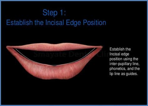 Smile Makeover South Delhi Smile Correction Gk 1 Delhi