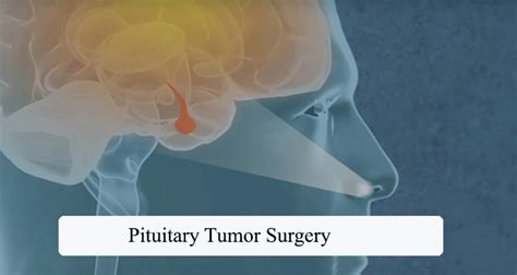 Is Pituitary Tumor Surgery Really A Safe Option For Removing The Tumor