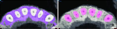Process Of Alveolar Bone And Tooth Segmentation In Mimics 19 0 Software