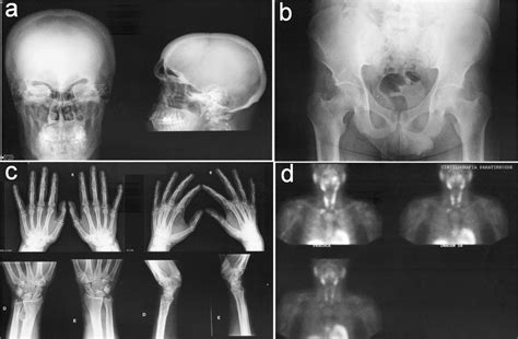 Hyperparathyroidism Jaw