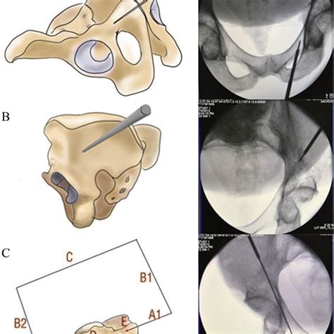 A Shows The Cross Section Of The Acetabular Notch Which Presents The