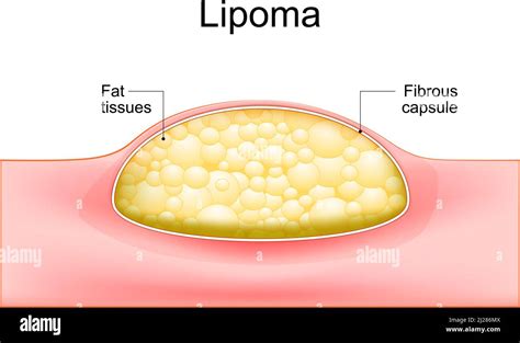 Subcutaneous Tissue 7 Disorders Of Subcutaneous Tissue In The Newborn