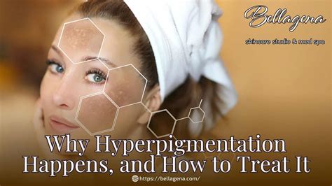 Why Hyperpigmentation Happens And How To Treat It Bellagena Med Spa