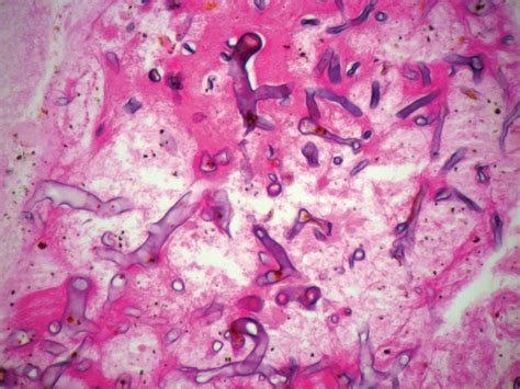 Resumo Sobre Mucormicose Diagnóstico Tratamento E Mais