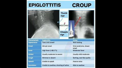Epiglottitis Thumb Sign