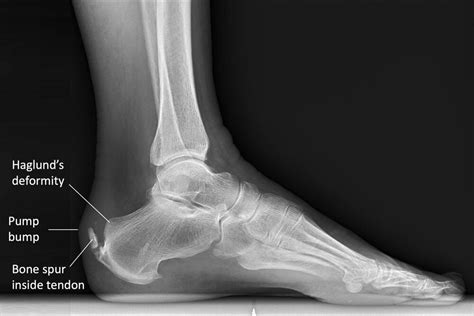 Insertional Achilles Tendon Tear