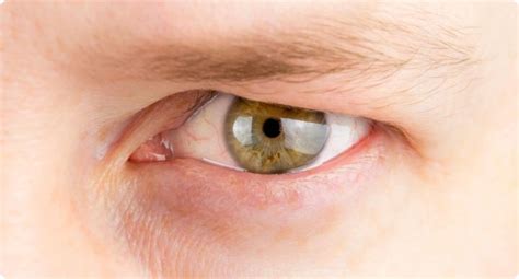 Virtual Field On Linkedin Understanding Ptosis And The Superior 36