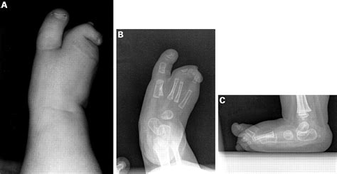 Split Hand And Foot Syndrome Split Hand Syndrome And Syndrome Of