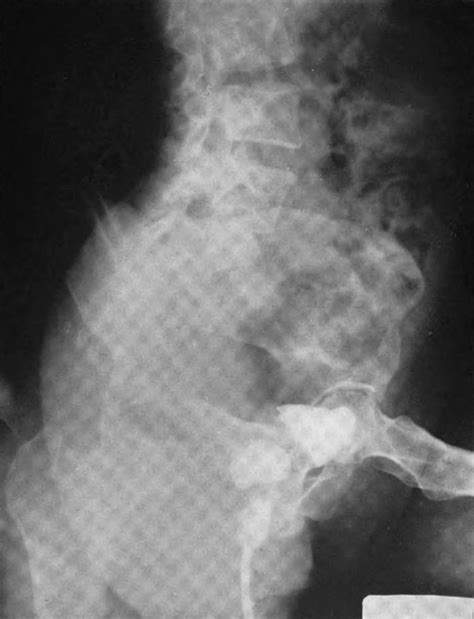 Urethral Diverticulum Alchetron The Free Social Encyclopedia