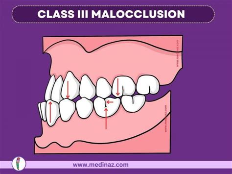Angles Classification Malocclusion Dental Notes
