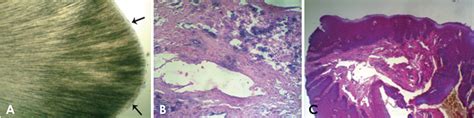 Enamel Renal Syndrome With Associated Amelogenesis Imperfecta