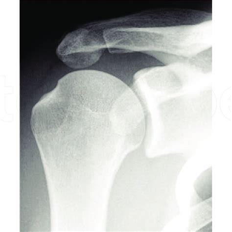 Coracoid Impingement Download Scientific Diagram