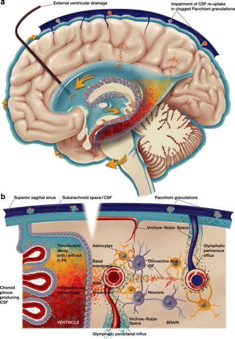 Intraventricularly Brain Bleed Intracranial Hemorrhage Causes