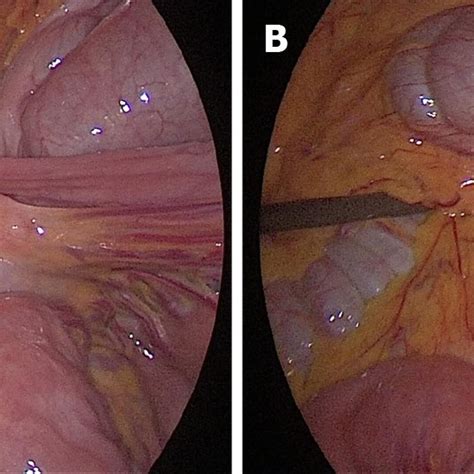 Exploratory Laparoscopy A Dilated Duodenum In The First And Second Download Scientific