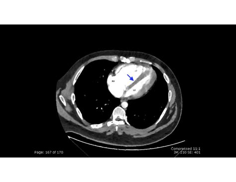 Saddle Pulmonary Embolus Cta Annotated Blue Arrow 1 Jetem 2019 Jetem
