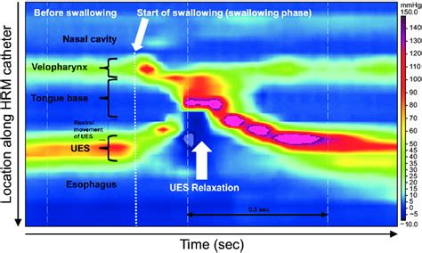 Upper Esophageal Sphincter Manometry