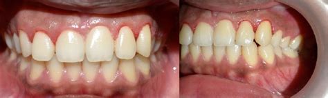 Immediate Post Surgical Pictures After Laser Gingivoplasty Download Scientific Diagram