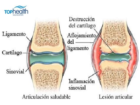 Qué Es La Artrosis Y Cómo Frenar Sus Síntomas Kojjo