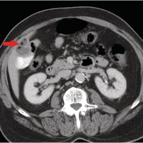 Pdf Air In Gallbladder Emphysematous Cholecystitis Or Else