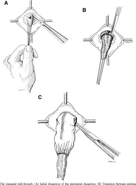 Figure 2 From Laparoscopic And Transanal Pull Through For Hirschsprung