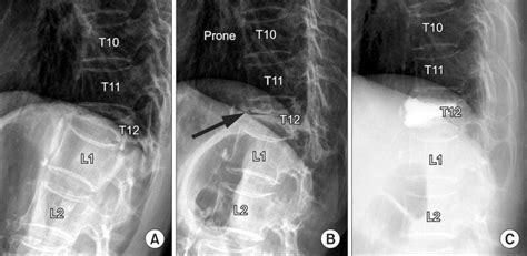 The Illustration Of Intravertebral Instability For T12 Compression