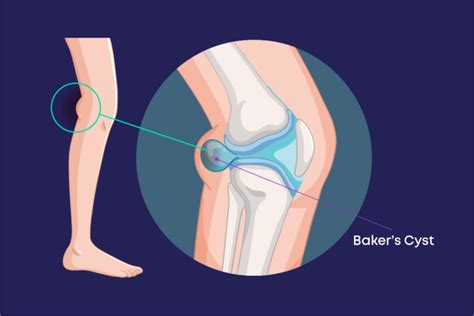 Rupture Of Bakers Cyst Symptoms Kltg