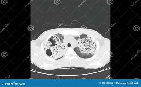 Cavitation Cartoons Illustrations And Vector Stock Images 40 Pictures