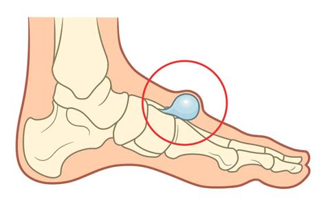 Top Of Foot Swollen [causes Symptoms And Best Home Treatment]