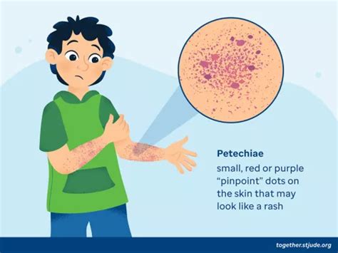 Thrombocytopenia Low Platelets Together By St Jude™