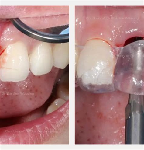 Buccal Bone Augmentation During Immediate Implant Placement Nobel Biocare