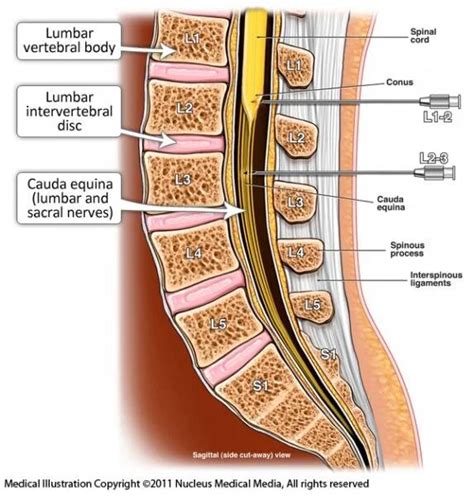 Ct Myelogram Ct — Knotry