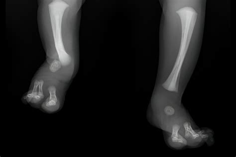 30 Facts About Hecht Scott Syndrome