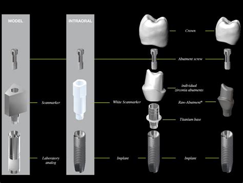 Types Of Abutment