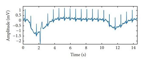 Ecg Signal Corrupted By Baseline Wander 11 Download Scientific Diagram