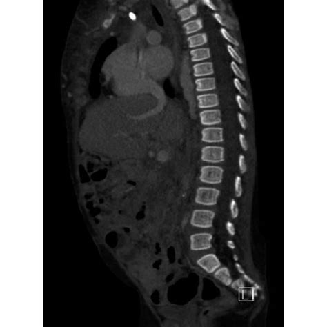 Computed Tomographic Angiogram Showing A Completely Occluded