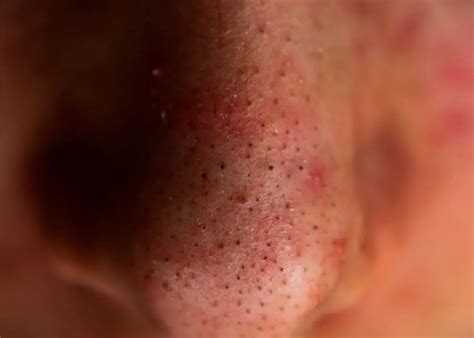 Whiteheads And Blackheads Treatment The Laser Club