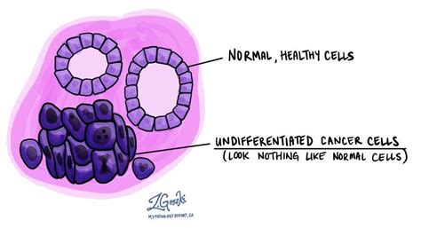 Undifferentiated Mypathologyreport Ca