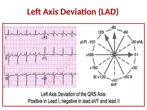 Lecture On Cardiac Axis On Ecg For Nurses Ppt