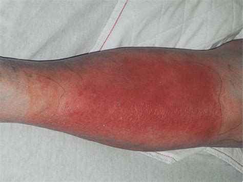 Erysipelas In History Erysipelas Causes And Treatment Dermatology